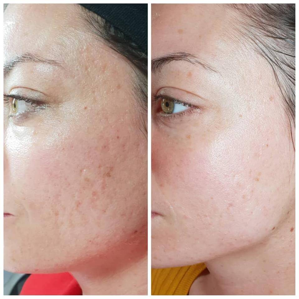 Scar Removal Gallery - Forever Clinic | Cheltenham Aesthetics