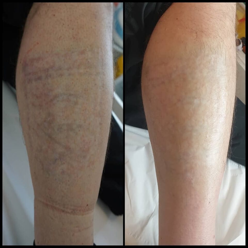 Scar Removal Gallery - Forever Clinic | Cheltenham Aesthetics