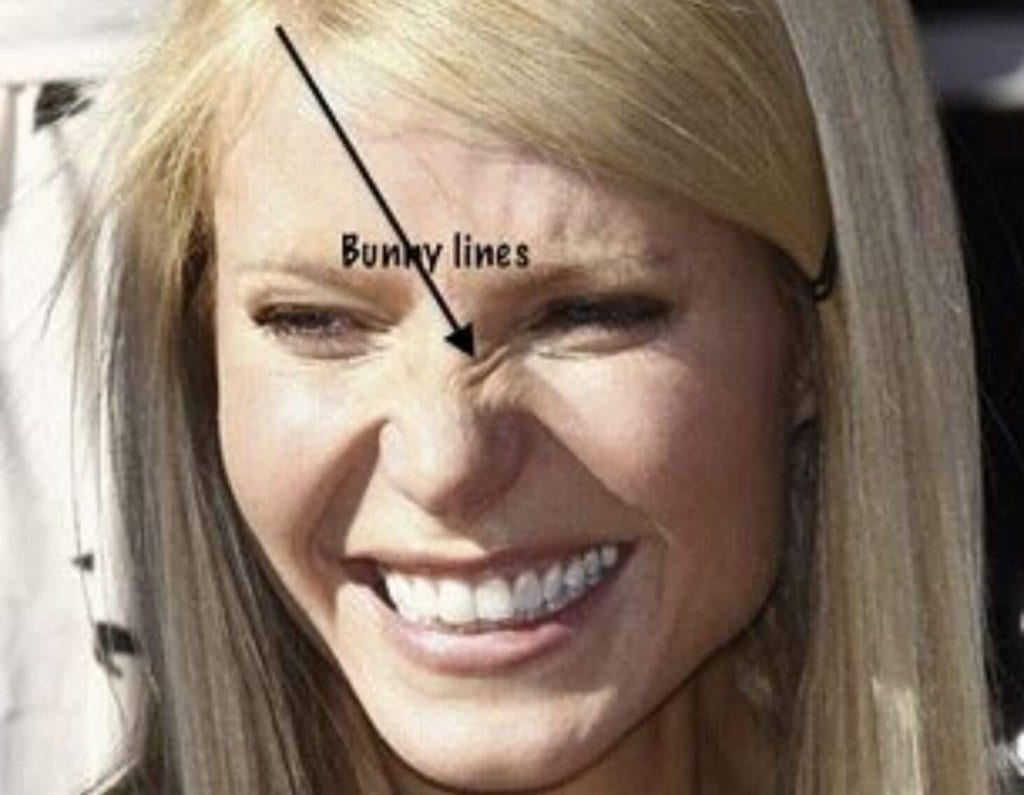 Botox ® Wrinkle Relaxing Injections Cheltenham - Forever Clinic ...